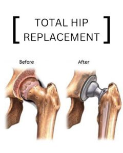 Understanding Bipolar Hemiarthroplasty vs Total Hip Replacement - Jain ...