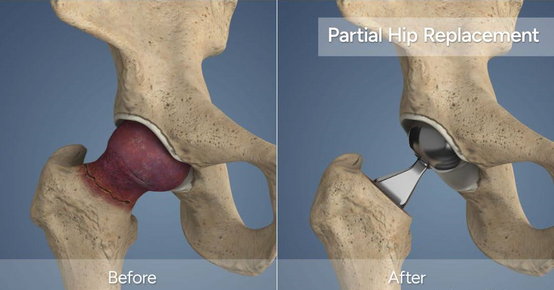 Understanding Bipolar Hemiarthroplasty vs Total Hip Replacement - Jain Multispecality Hospital